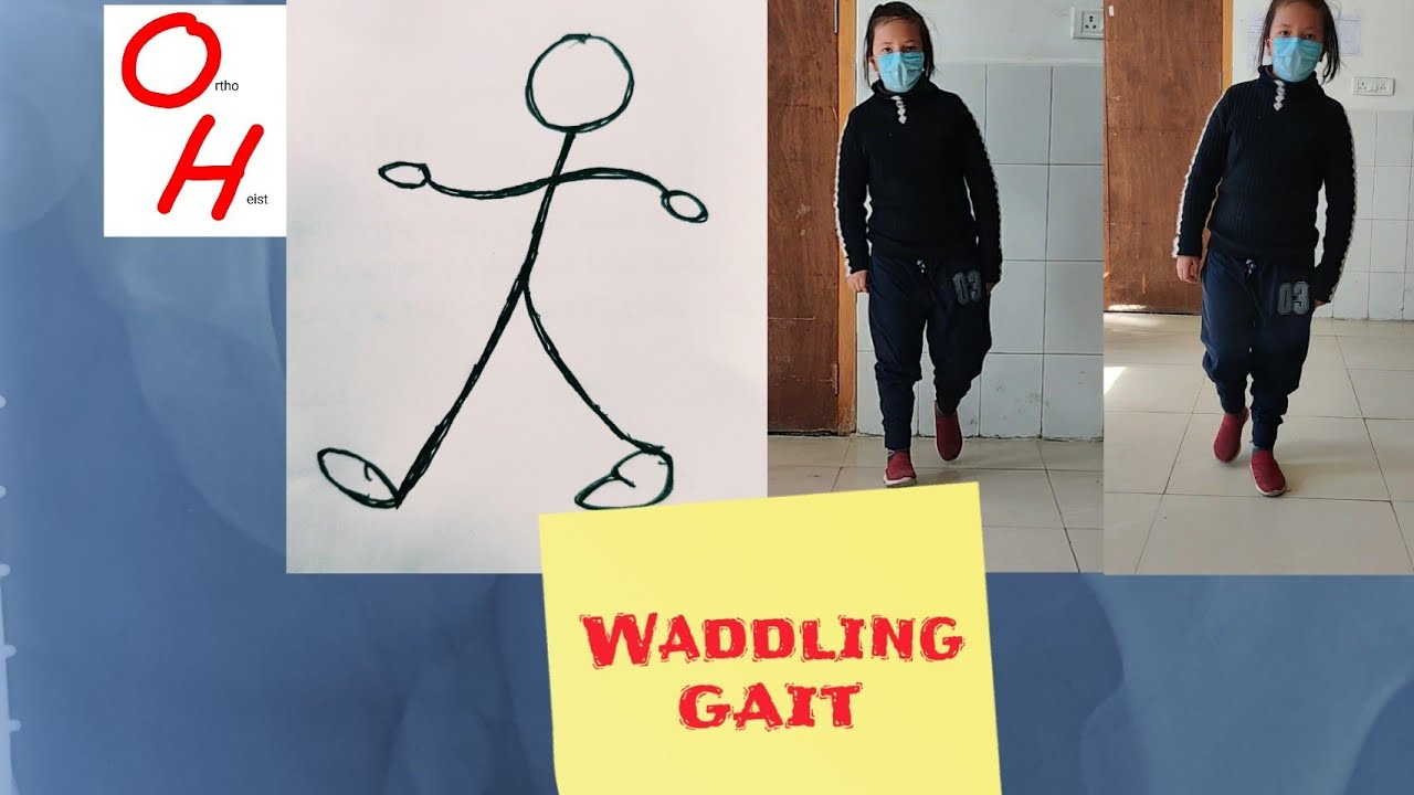 Waddling gait - YouTube