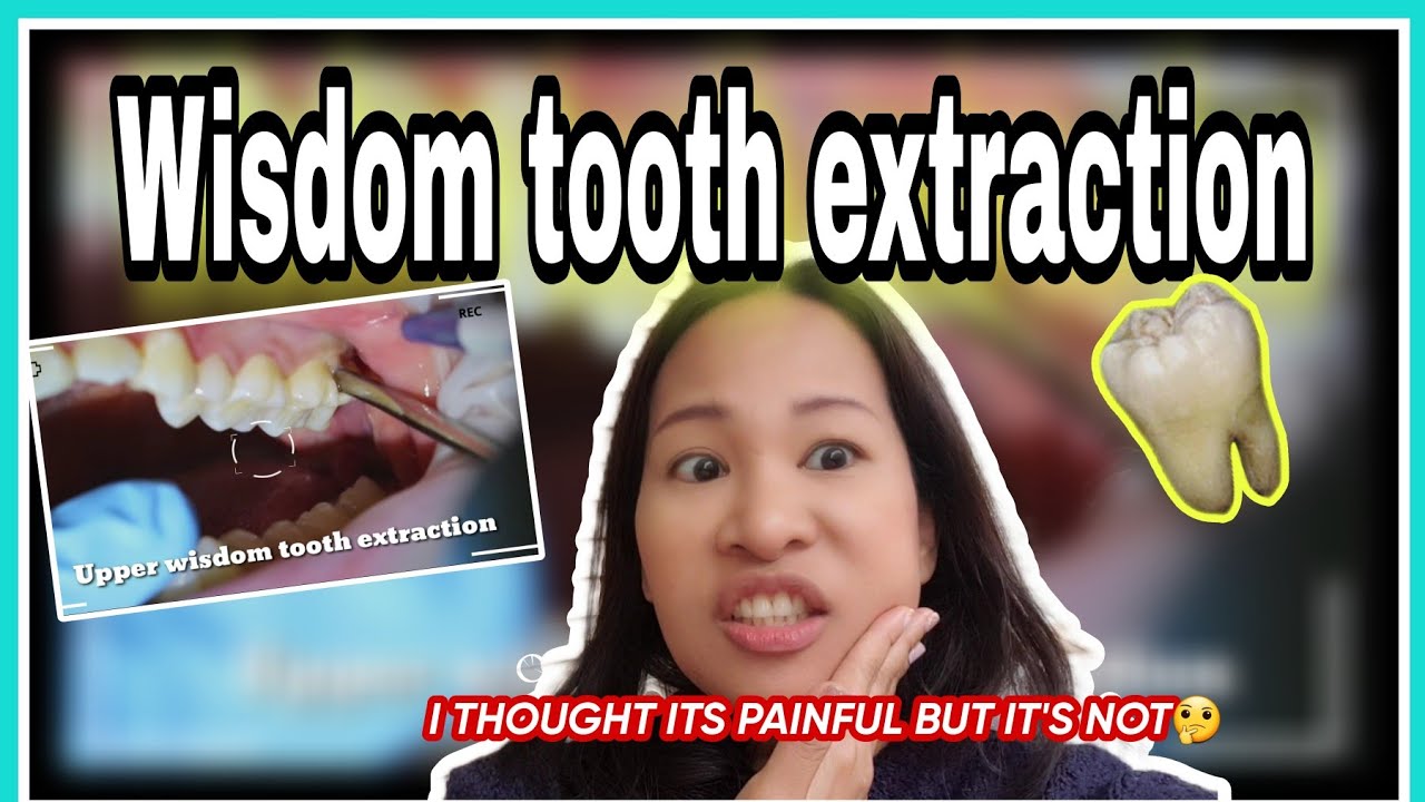 MY WISDOM TOOTH GOT PULLED OUT MY EXPERIENCE MASAKIT BA? - YouTube