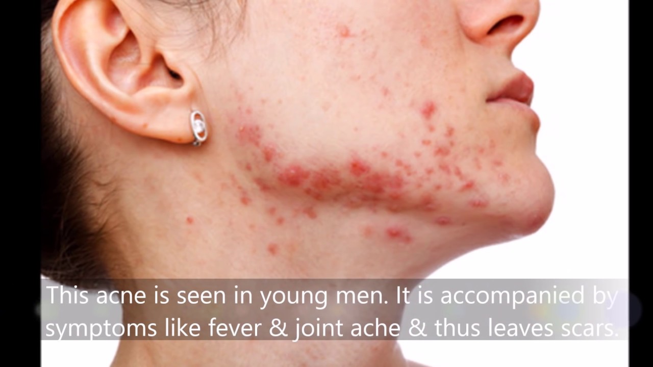 Different Acne Types & Identification - YouTube