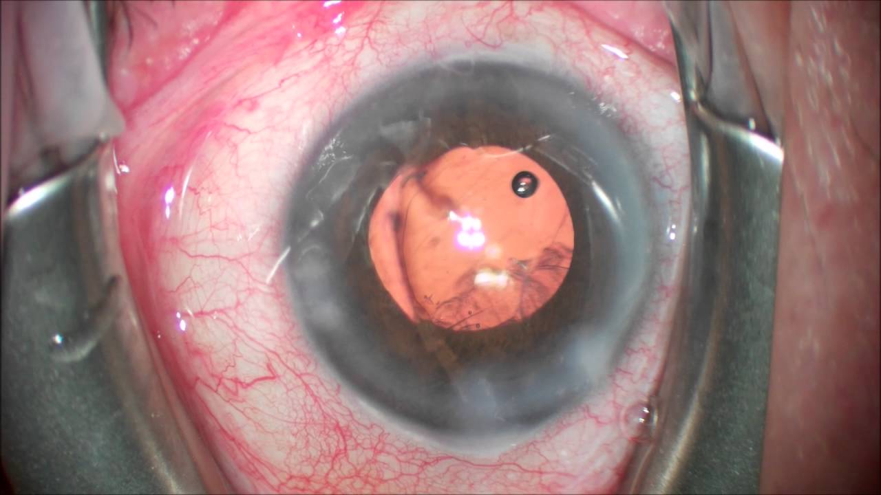 Pearl: Sub-incisional cortex, easy removal after IOL implantation ...