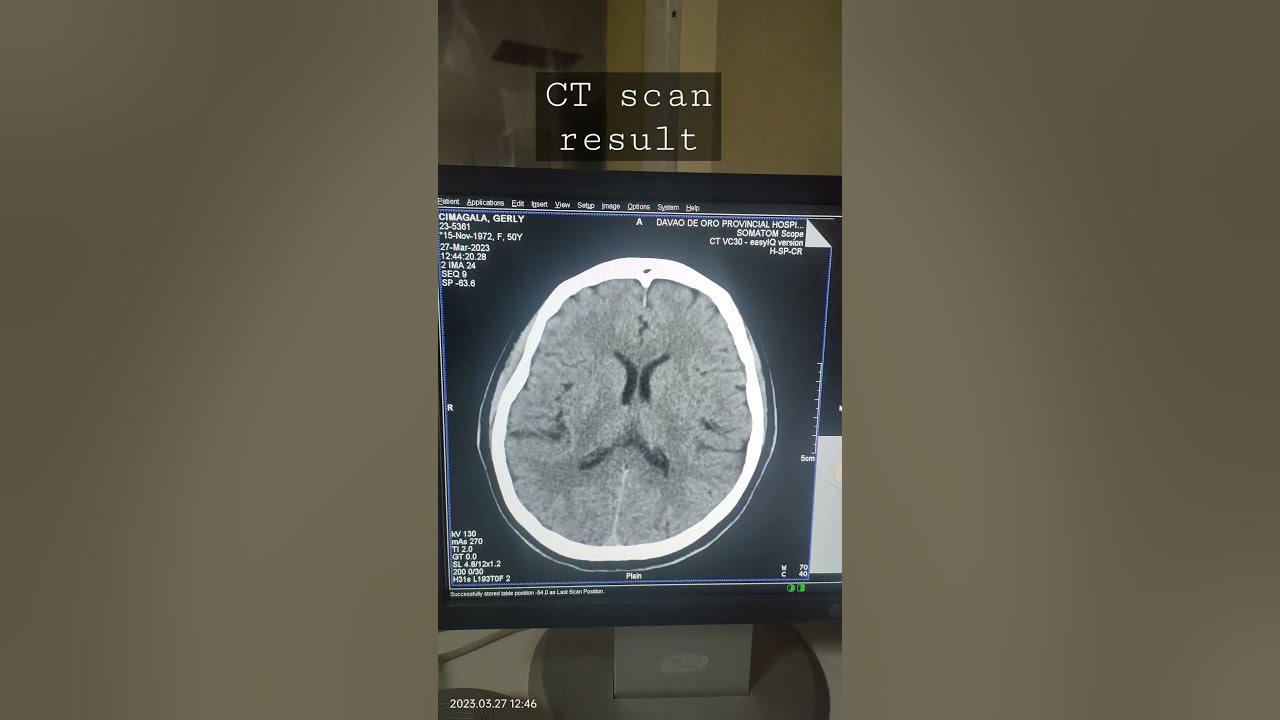 CT scan result - YouTube