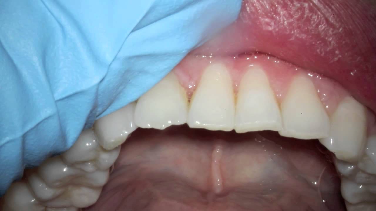 Slide on third molar when teeth occlude which may lead to patient's ...