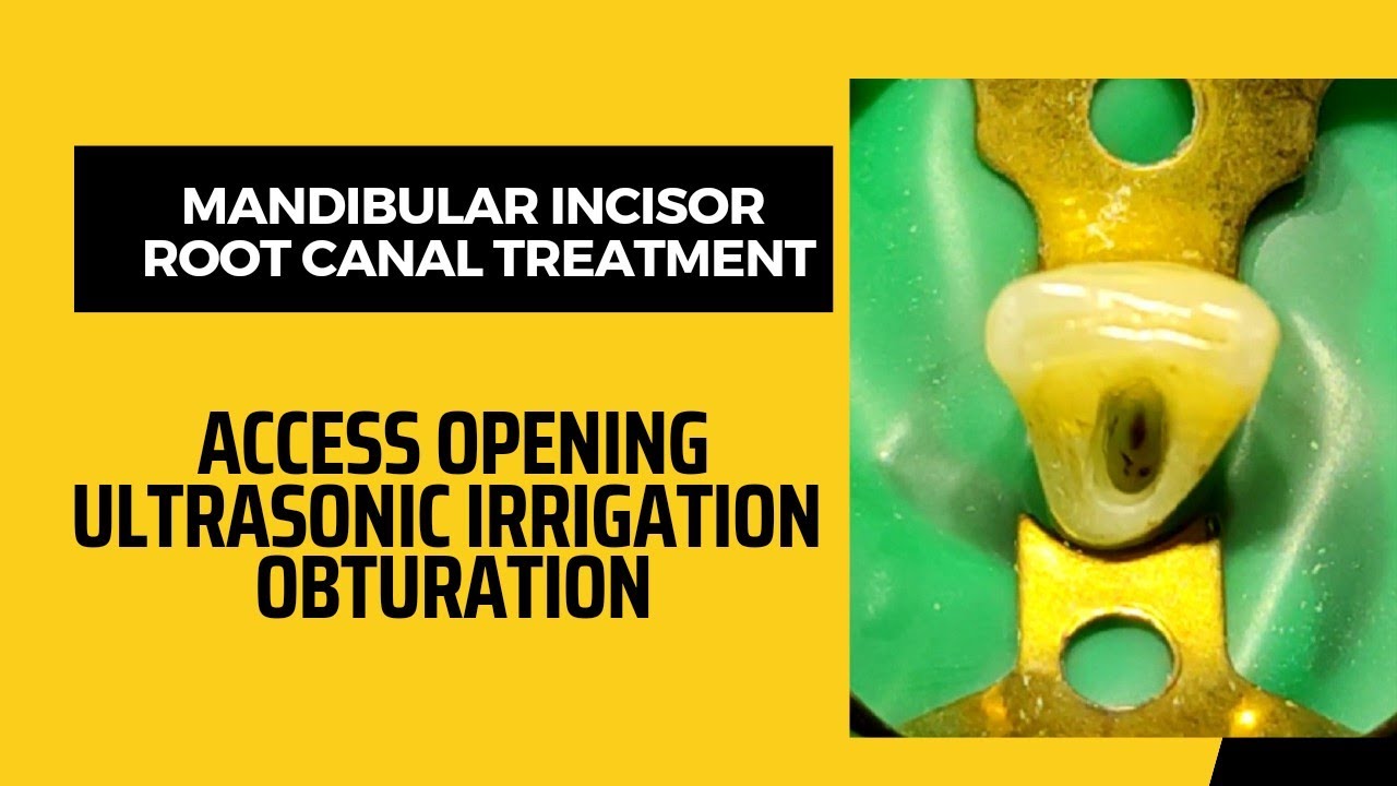 Mandibular Incisor Root Canal Treatment l Access Opening l BMP l ...