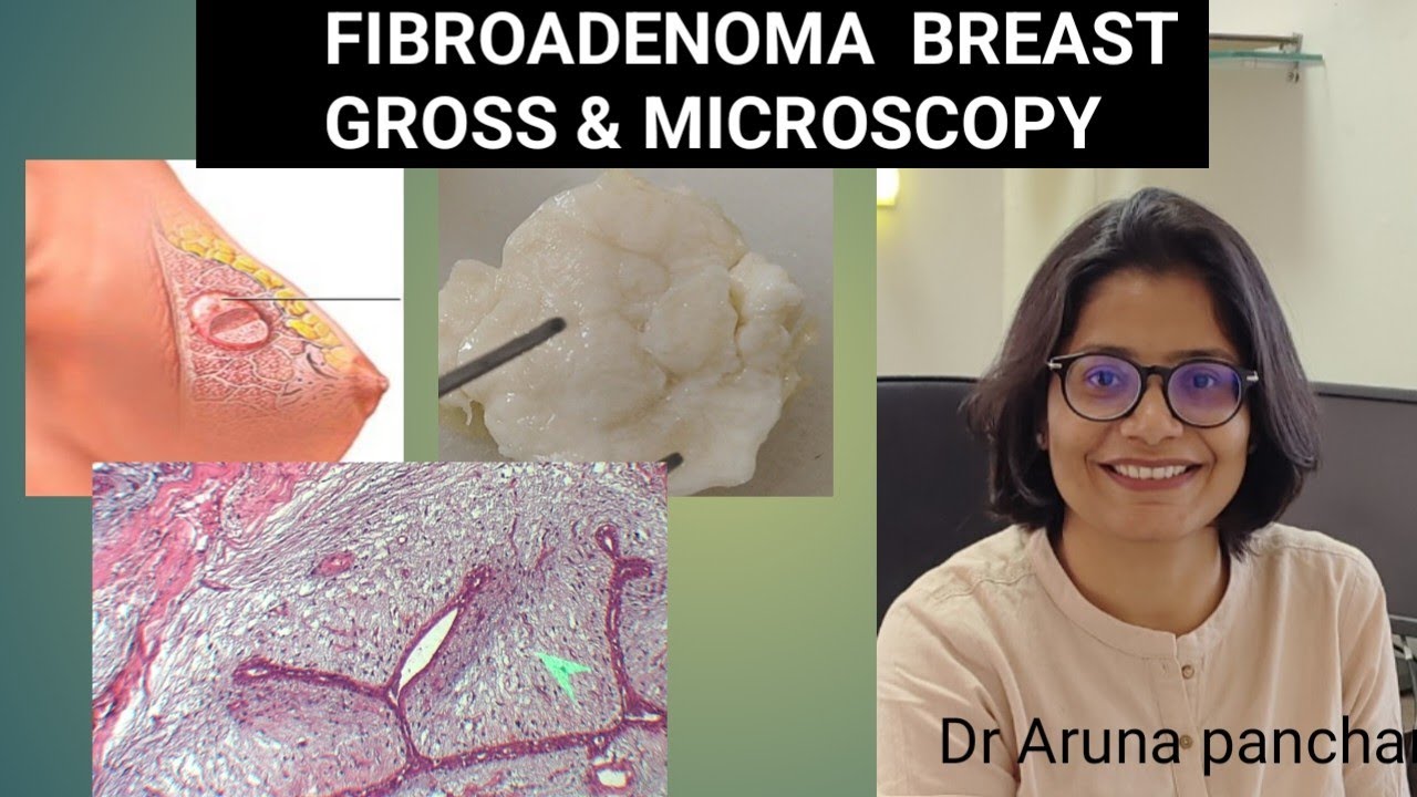 Microscopy Of Fibroadenoma Breasthistopathology For Mbbs And Mdpathology Grossbreast Tumour