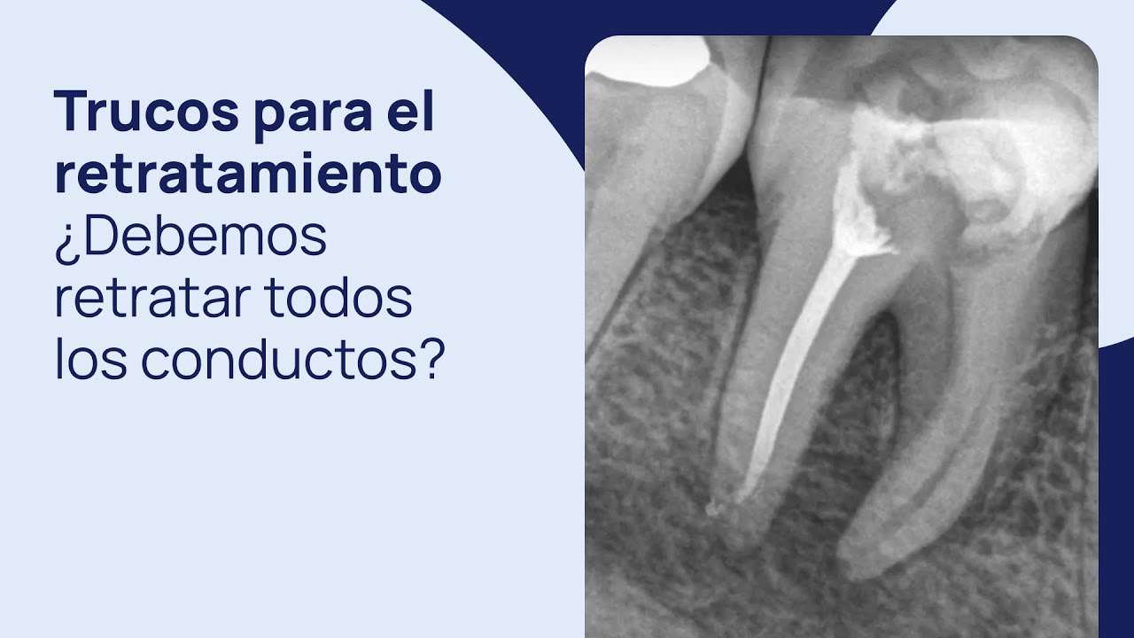Trucos para el retratamiento ¿Debemos retratar todos los conductos ...