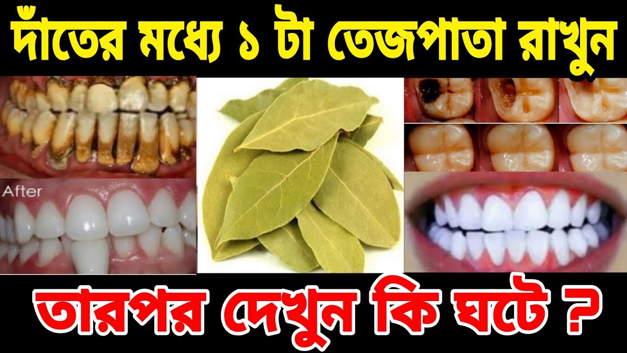 দাঁতের ভিতরে একটা তেজপাতা রাখুন তারপর দেখুন কি ঘটে বেঁচে যাবে কোটি কোটি টাকা Youtube