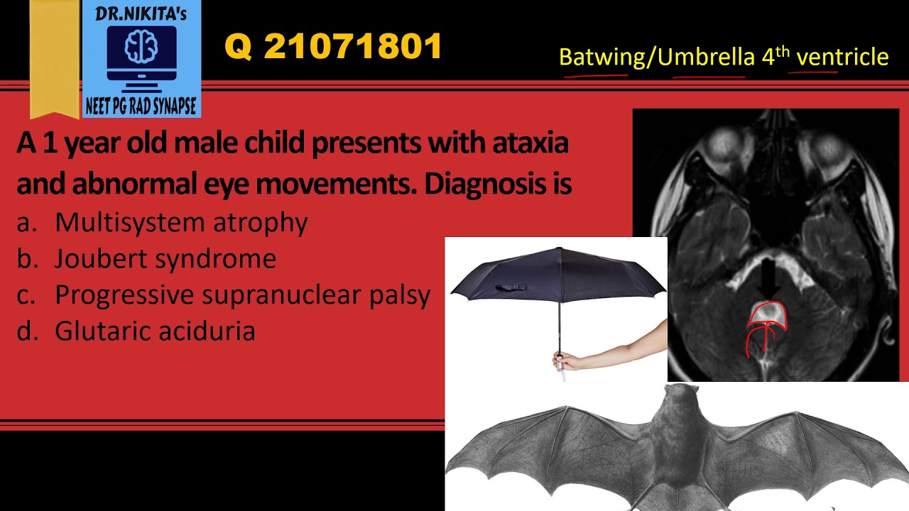 Joubert syndrome- Synopsis - YouTube