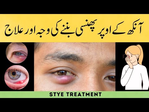 Stye treatment - Aankh per dana ka ilaj- Aankh ki sujan ka ilaj
