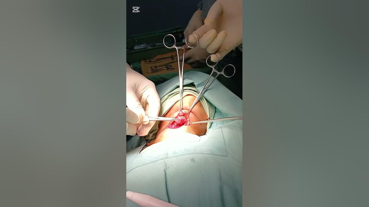 Sistrunk Procedure for thyroglossal cyst - YouTube