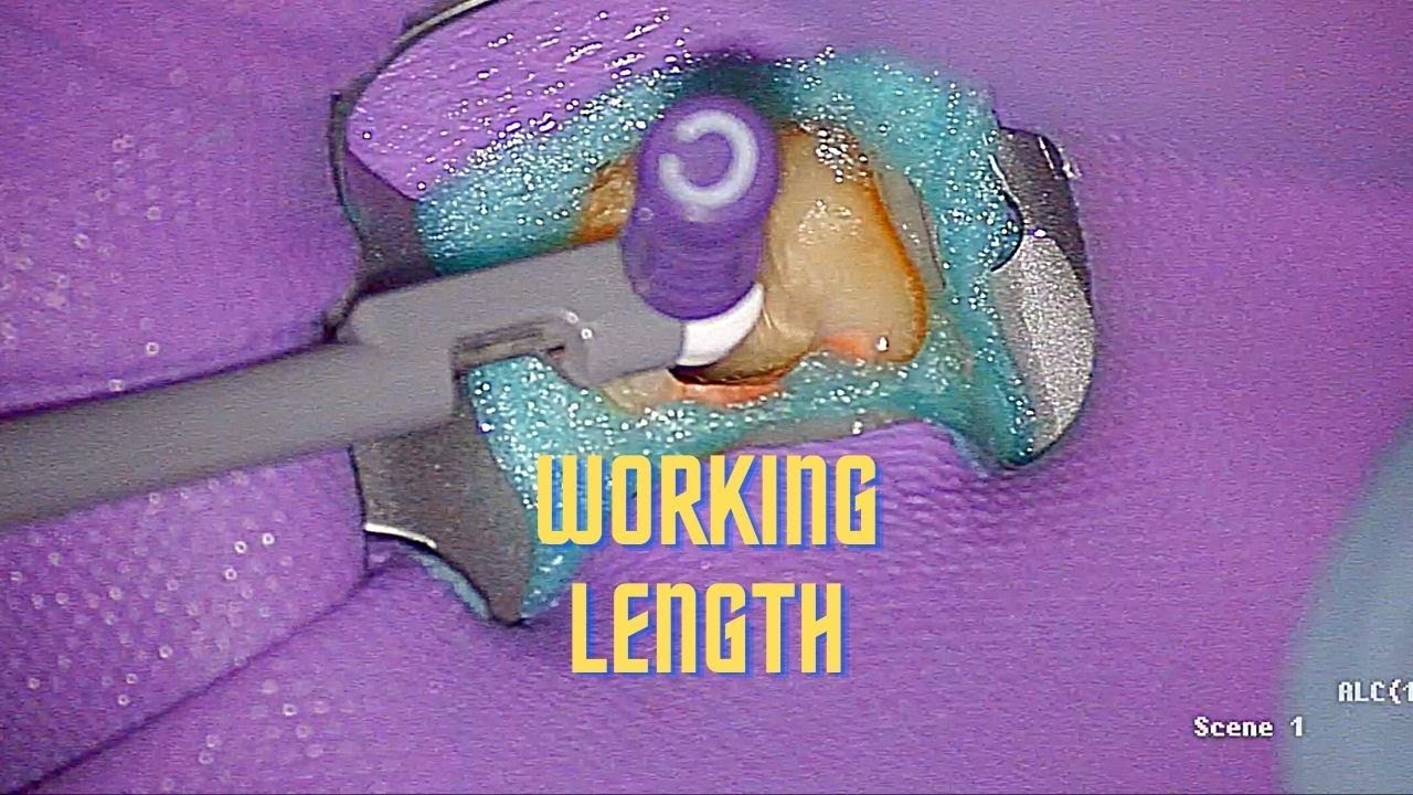 Simple Root Canal Working Length Tip - YouTube