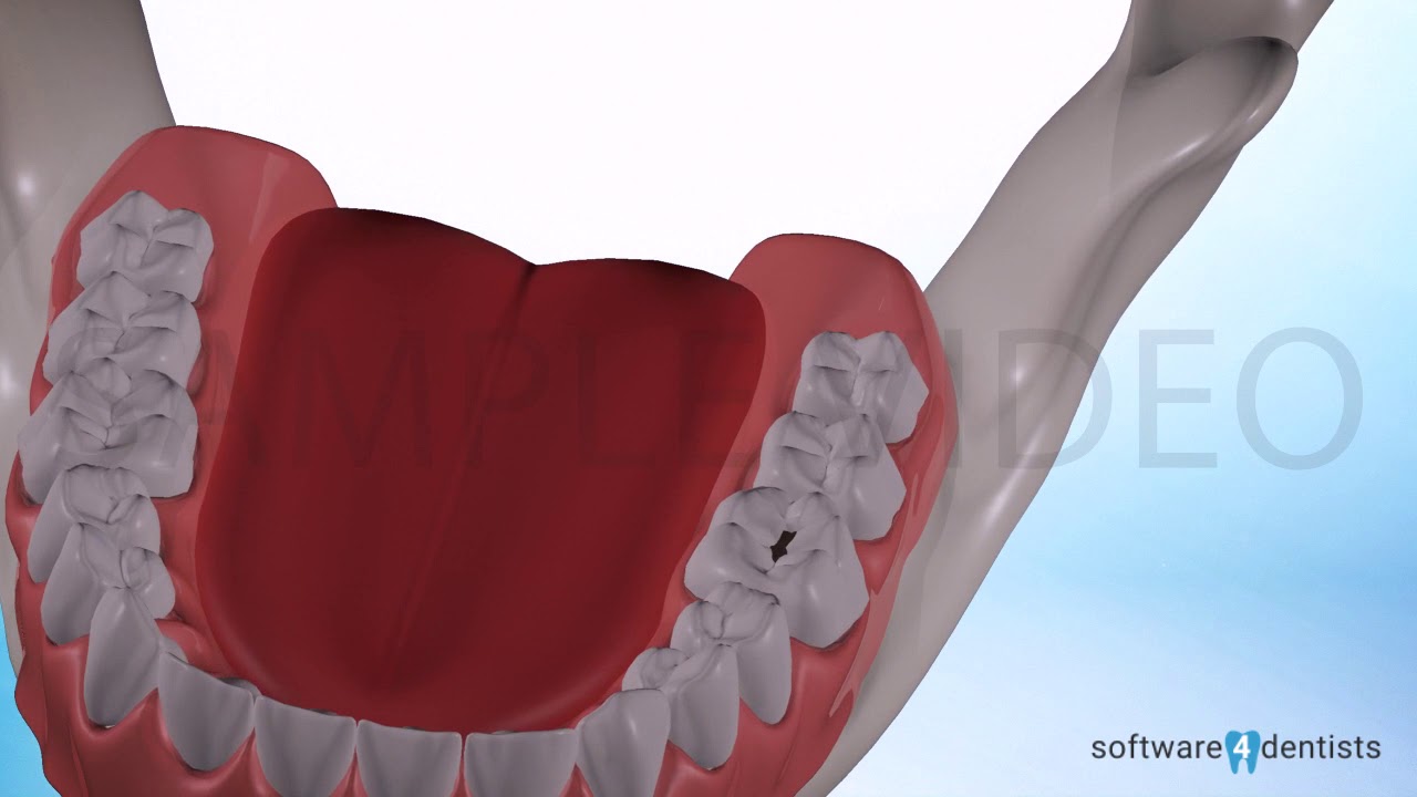 Tooth restoration procedure animation - YouTube