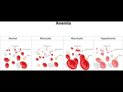 Pandu roga- 3, Differential diagnosis & practical aspects of pandu roga ...
