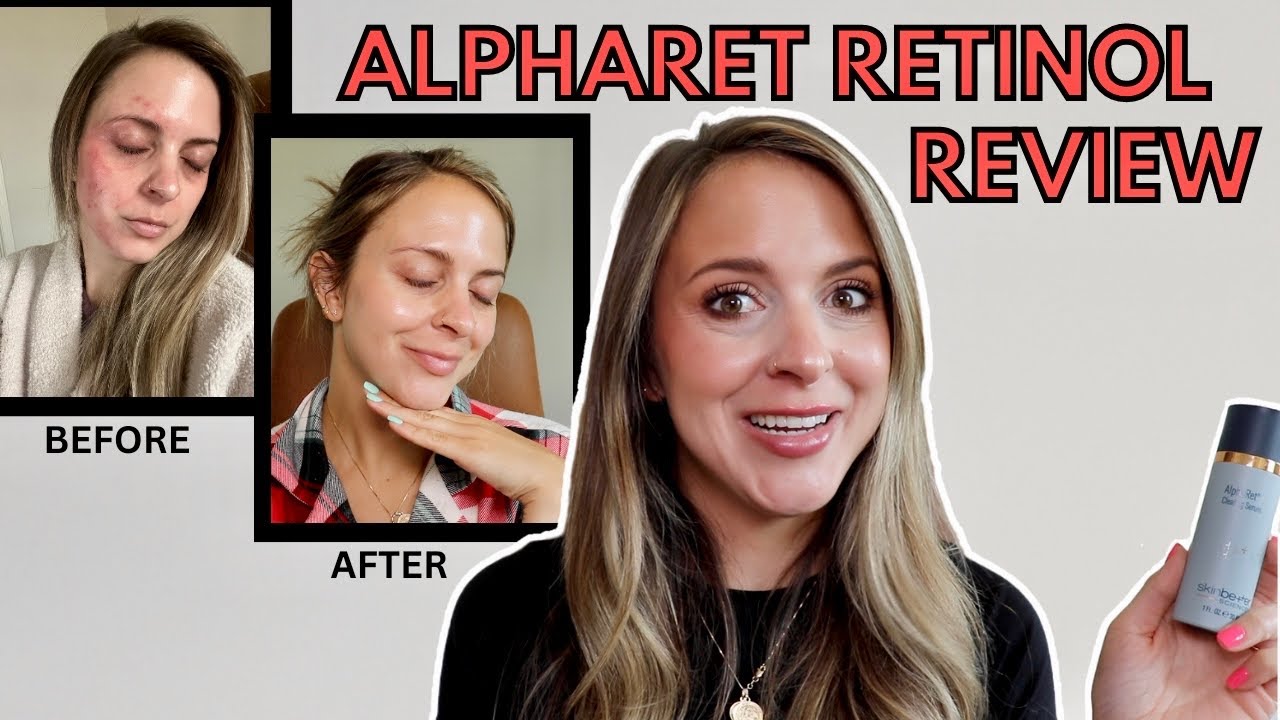 ALPHARET CLEARING SERUM RETINOL: MY EXPERIENCE & 4 MONTH RESULTS: Is It ...
