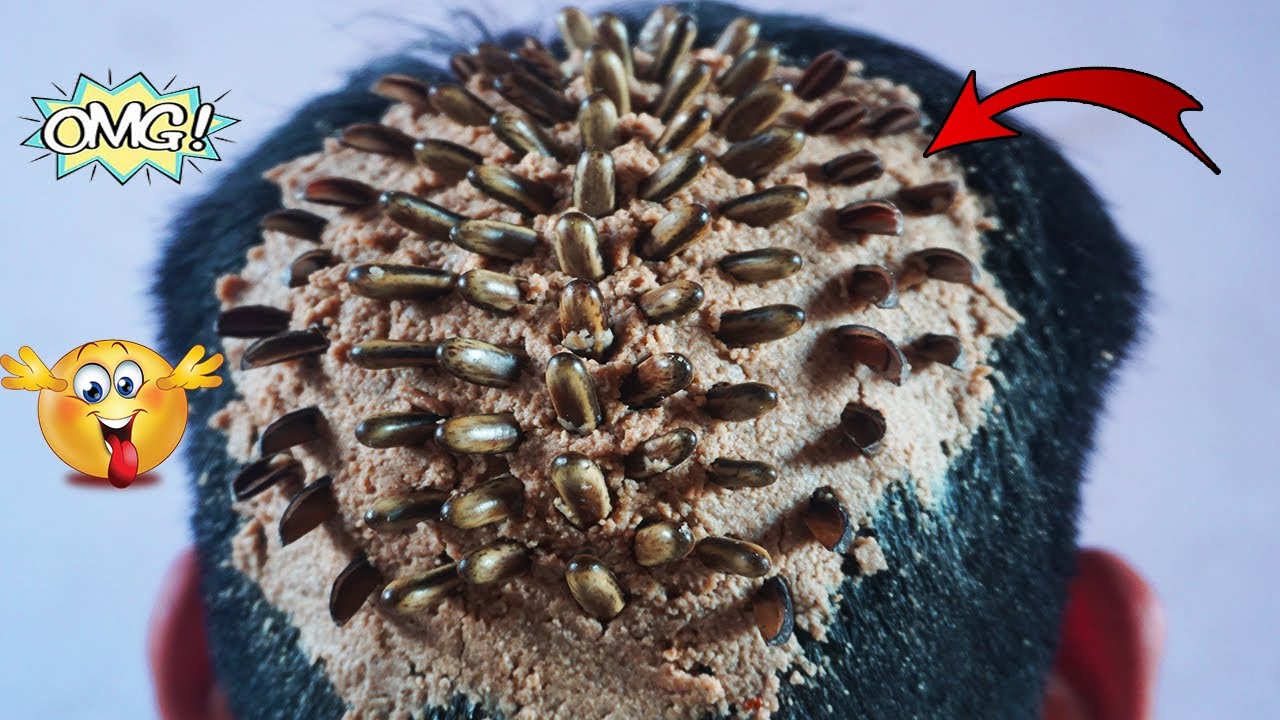 OMG ! Million Worms On Dandruff Removal #1260 - YouTube