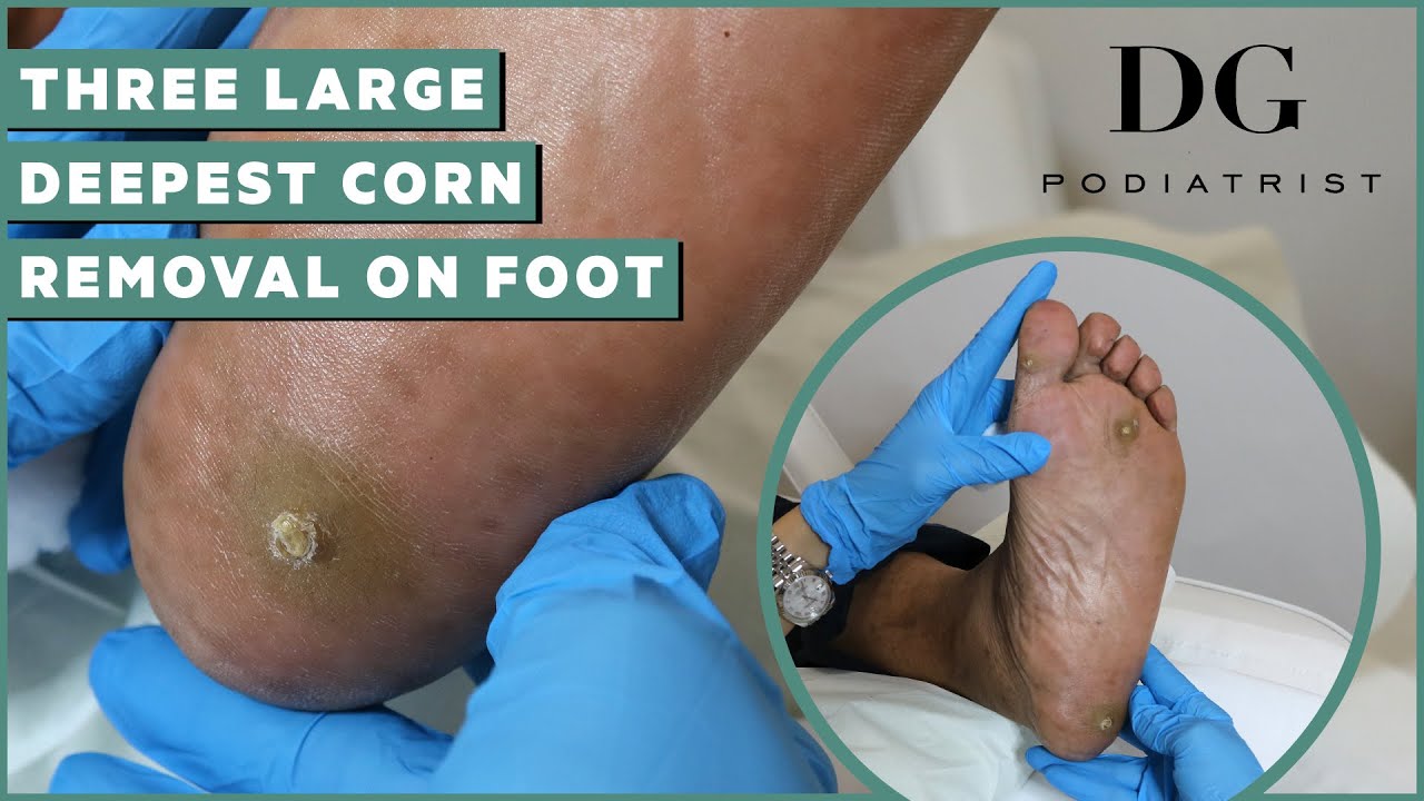 Triple Deepest Corn Removal | The Foot Scraper: DG Podiatrist - YouTube