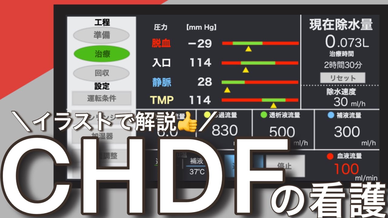 敗血症でも実施される持続透析 CHDFの看護や管理について - YouTube