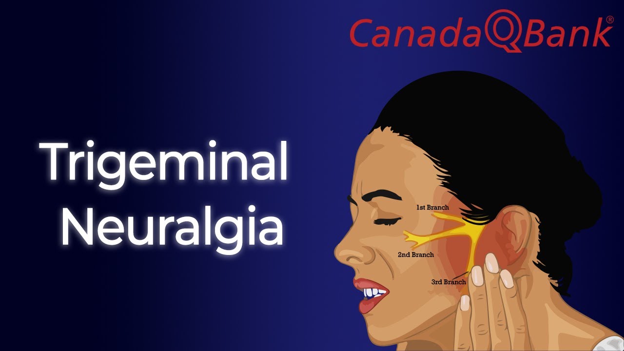 Trigeminal Neuralgia - YouTube