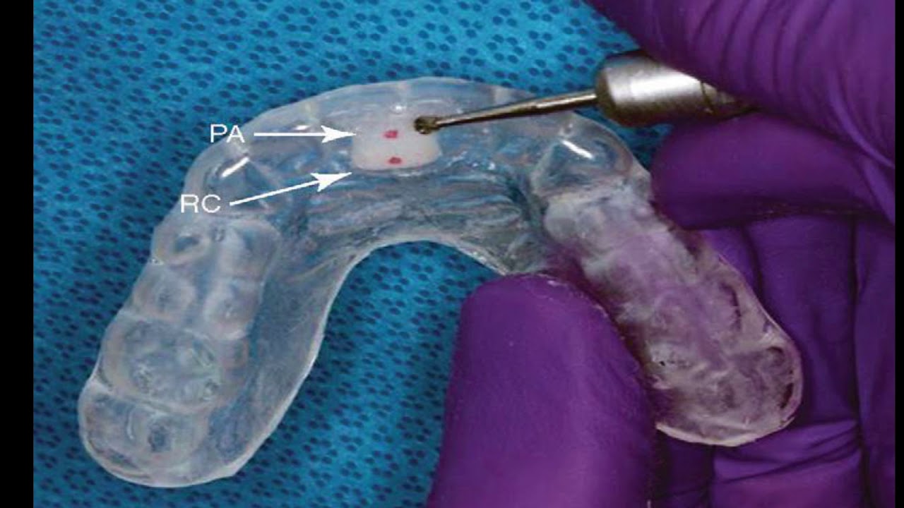 FÉRULA REPOSICIONAMIENTO ANTERIOR - YouTube