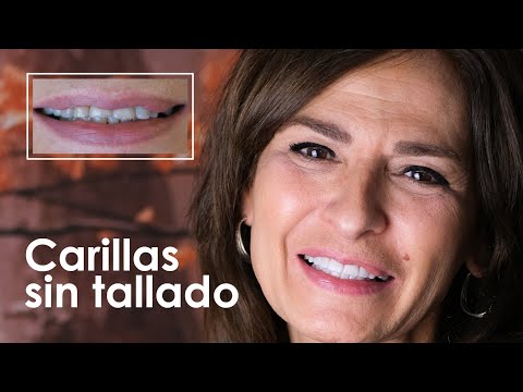Nº1 en Carillas Inyectadas | Precio, Tratamiento y Ventajas