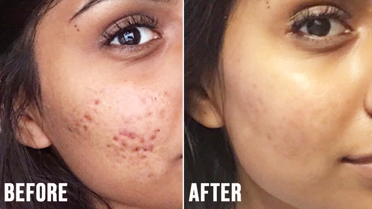 Acne Treatment with Acne Cure Cream Review [Self Experienced] - YouTube