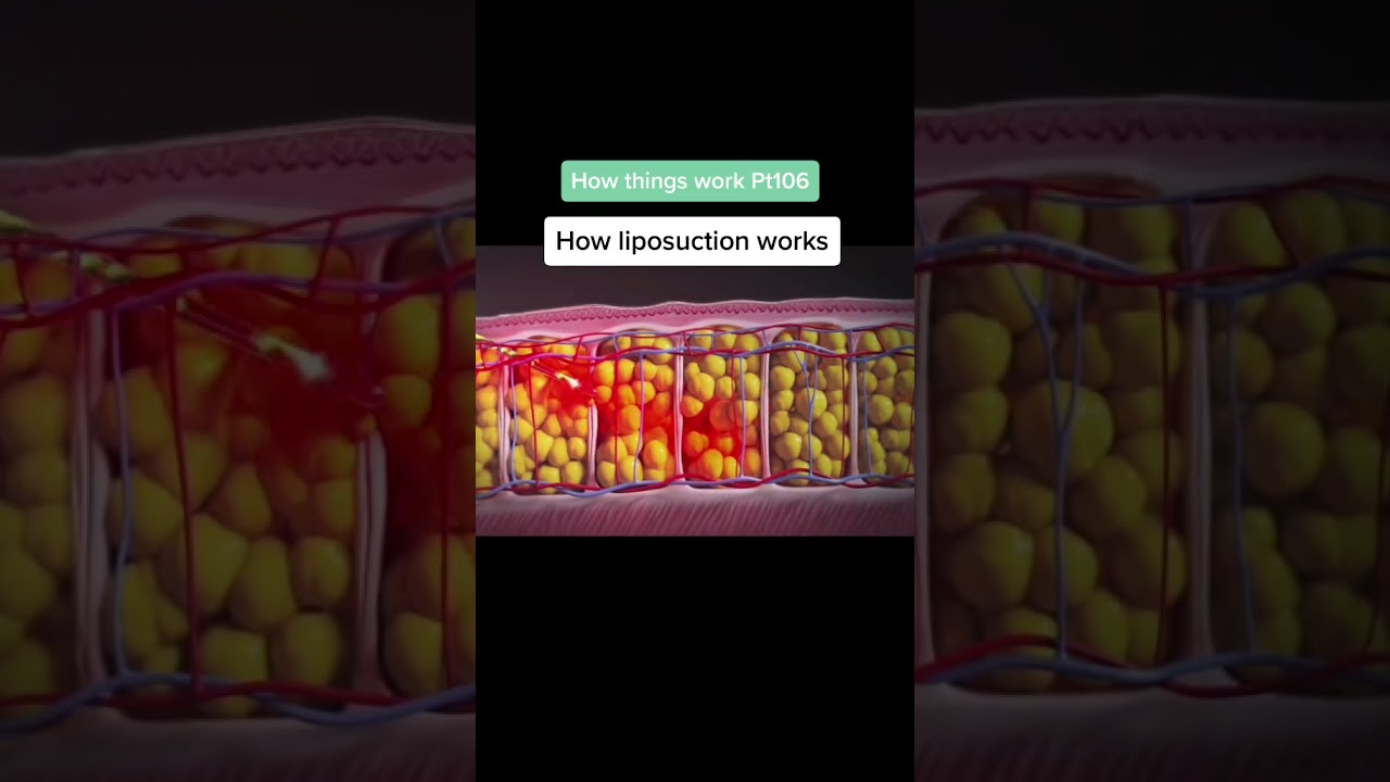 How Liposuction works #How things work #shorts - YouTube