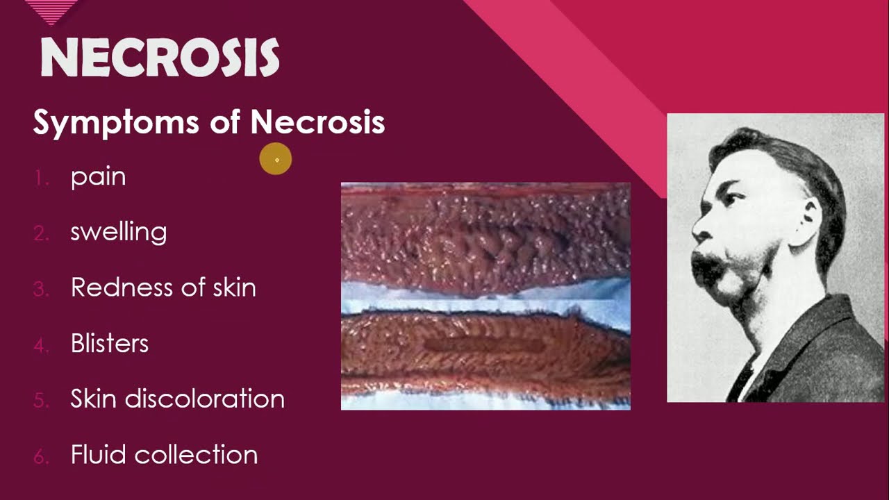 Necrosis Class 9 | What is Necrosis | Unprogrammed cell death - YouTube