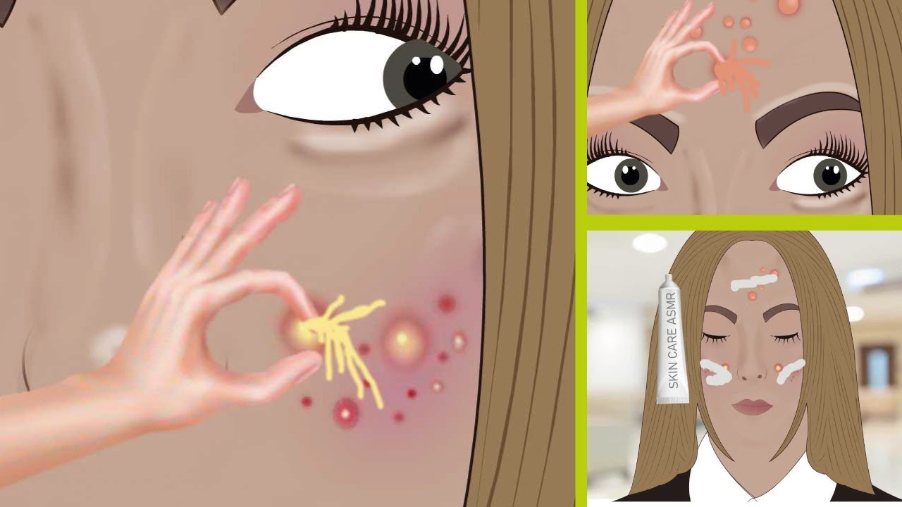 ASMR Satisfying Juicy Pimple Extraction/ Whitehead Extraction // Stop ...