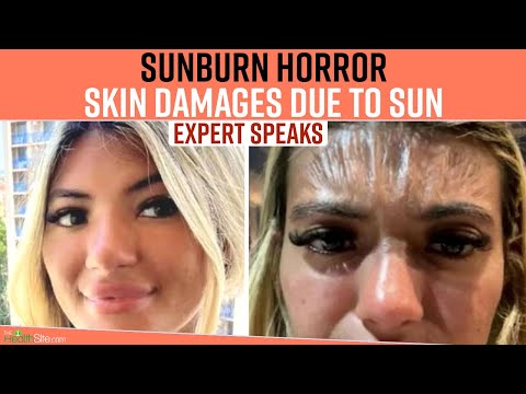 Sun Exposed Skin Got A Woman's Forehead Of Plastic In Bulgaria, See ...