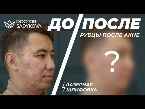 ЛАЗЕРНАЯ ШЛИФОВКА CO2: ГЛАДКАЯ КОЖА БЕЗ РУБЦОВ И ПОСТАКНЕ