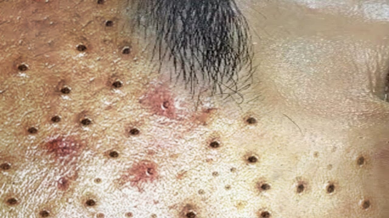 Loan Nguyen Acne Treatment 73p - YouTube