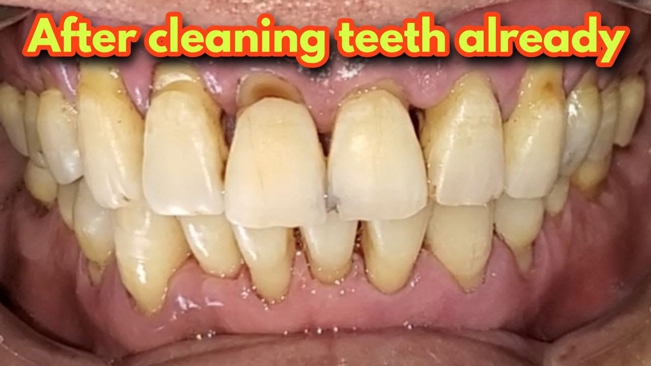 After cleaning teeth already ( TEETH SMILE RESTORATION ) - YouTube