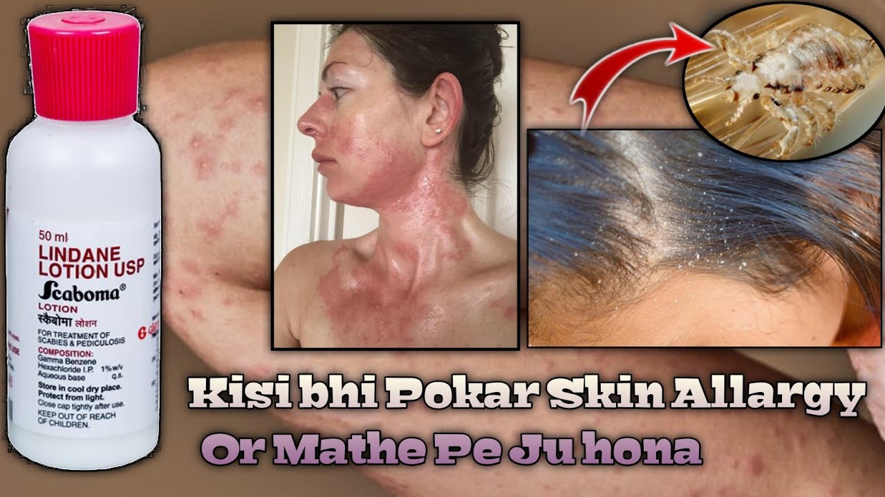 Scaboma Lotion! Gamma Hexachloride 1% Side Effects! Benefits! Uses # ...