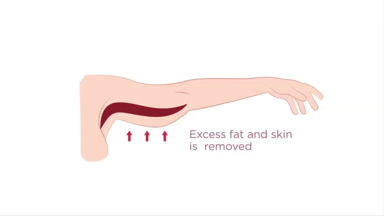 Brachioplasty Procedure | Memorial Plastic Surgery - YouTube