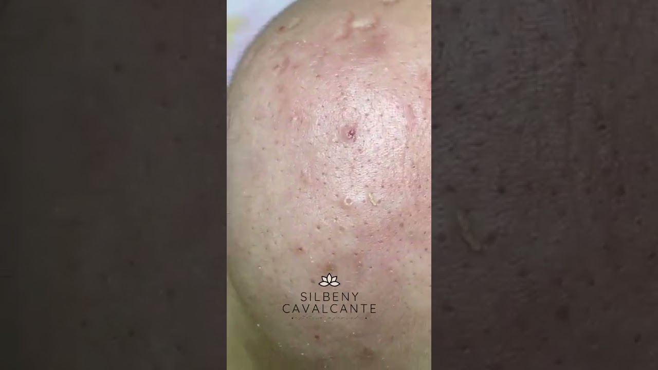 Cravos queixo #blackheadextraction #pimple #pimplepop#pimplepoppers # ...