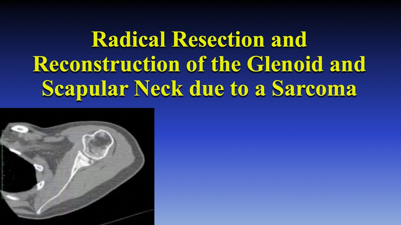Radical Resection and Reconstruction of the Glenoid and Scapular Neck ...