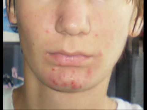 Curacne 40mg first month - YouTube