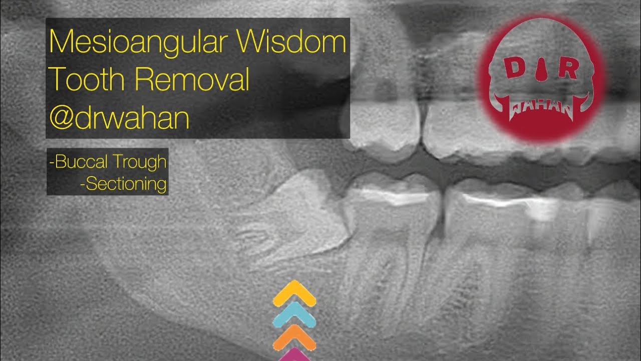 Mesioangular Wisdom Tooth Extraction just like in the Textbook - YouTube