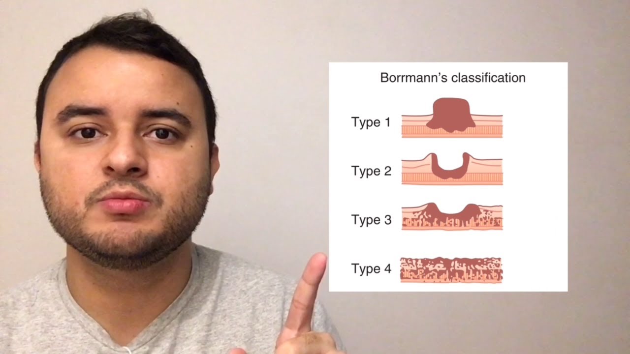 Classificação de BORRMANN - YouTube