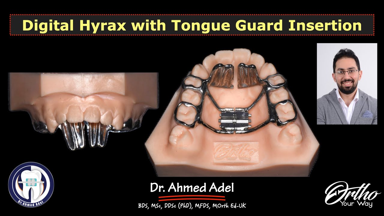 Digital hyrax (skeletal maxillary expander) and tongue guard (habit ...