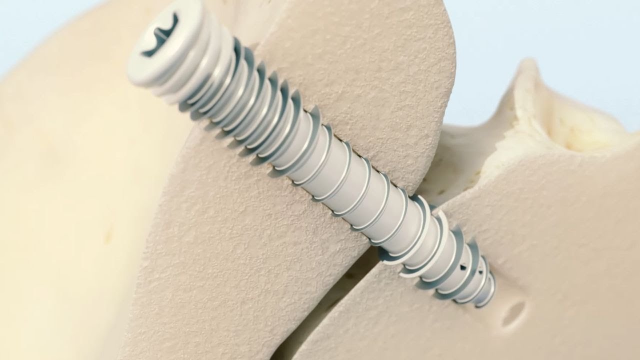 TransLoc 3D™ Patient Animation - YouTube