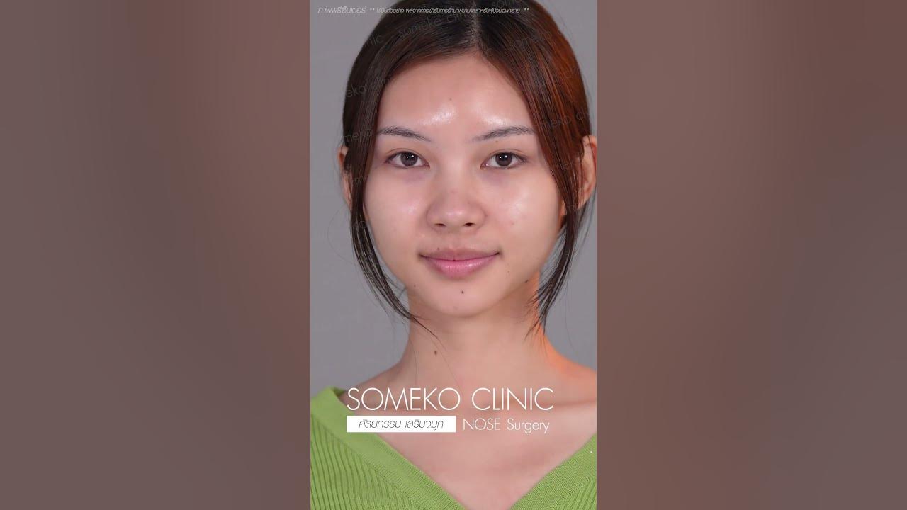 รวมลูกสาว #หมอตั้มsomeko จมูกเทคนิค SCT และ Secret Open ที่ Someko Clinic #โซเมโกะ #somekoclinic ...