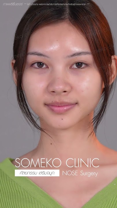 รวมลูกสาว #หมอตั้มsomeko จมูกเทคนิค SCT และ Secret Open ที่ Someko Clinic #โซเมโกะ #somekoclinic ...
