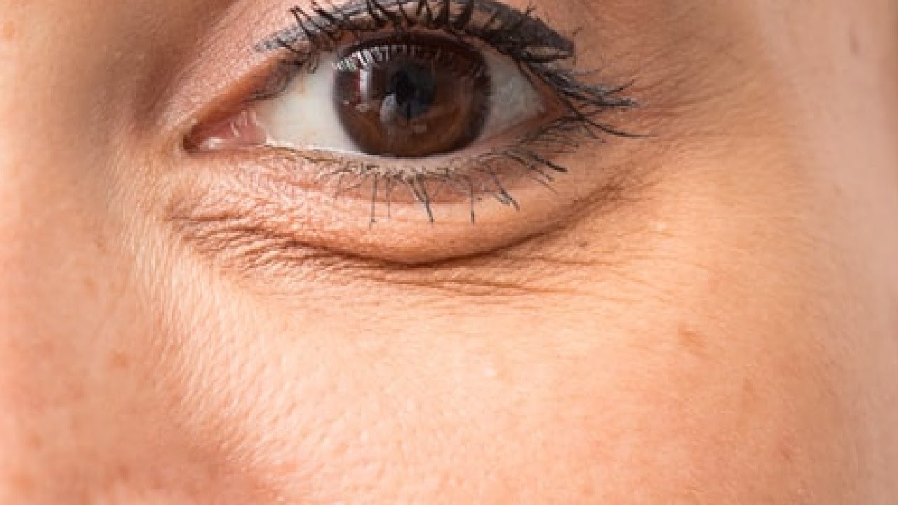 how to get rid of eye wrinkles when smiling permanently - YouTube
