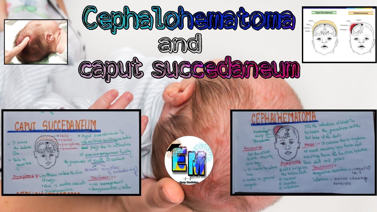 birth Injury 2|| caput succedaneum and cephalohematoma || # ...