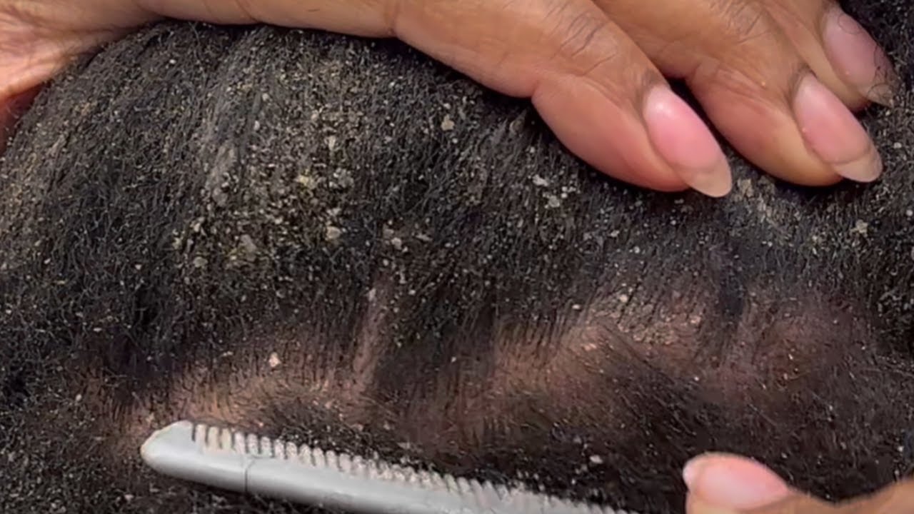 ASMR Scalp Cleaning + Scratching | extreme close up - YouTube