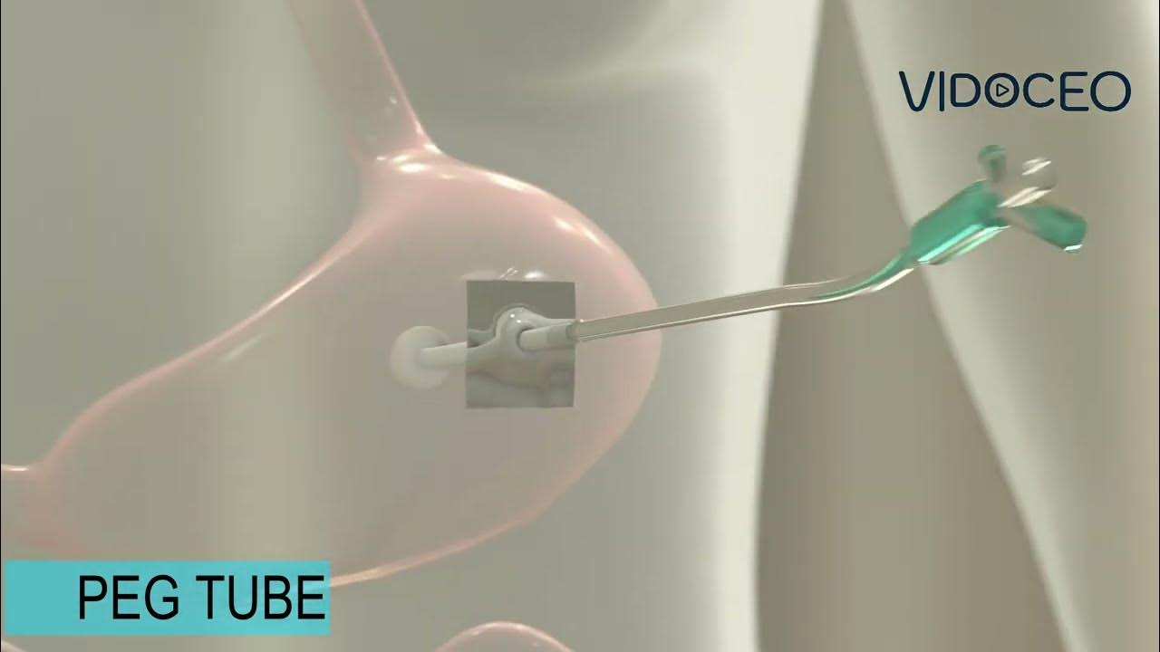 Percutaneous Endoscopic Gastrostomy (PEG) feeding tube animated explanation - YouTube