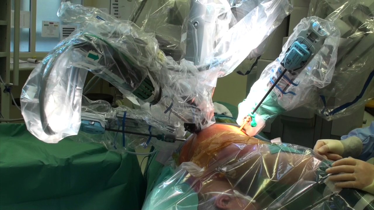 Port Placement for a Robotic Diaphragm Plication - YouTube