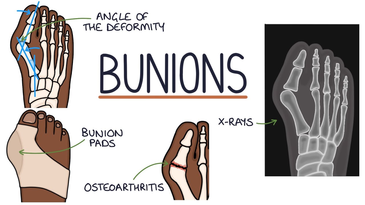 Understanding Bunions (Hallux Valgus) - YouTube