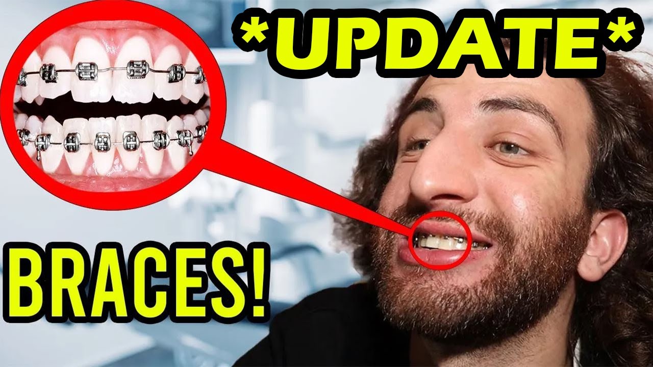 8 MONTH BRACES UPDATE! #braces #bracesupdate - YouTube
