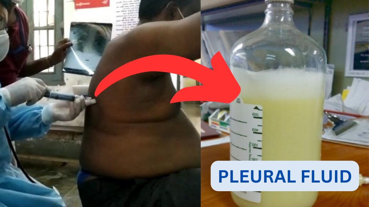 How To Aspirate Pleural Fluid | Pleural Tap Procedure - YouTube
